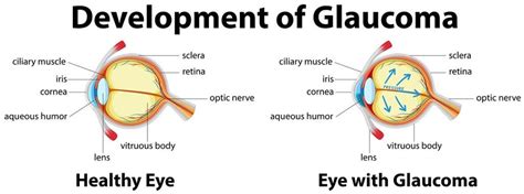 Glaucoma Detection Damage Assessment Via Deep Learning