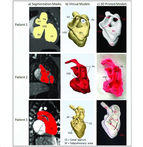 A Segmentation Masks B Virtual Models And C 3d Printed Models For Download Scientific