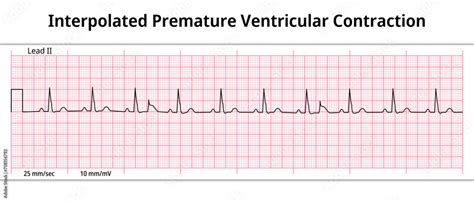 Ecg Interpolated Premature Ventricular Contraction Ventricular Extrasystole 8 Second Ecg