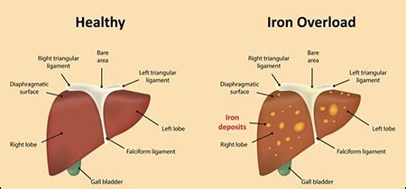 Iron Overload Disorder