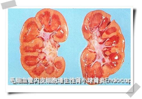 慢性肾炎图片 慢性肾炎症状表现图片大全 有来医生