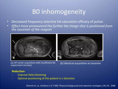 distortion artifacts in mri and their correction ppt