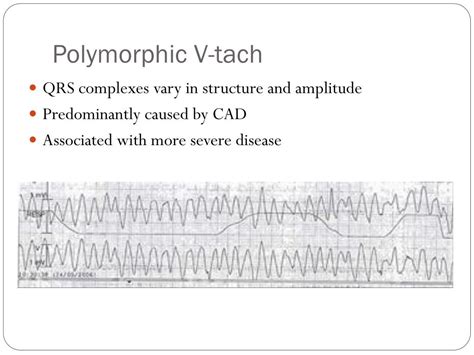 Ppt Cardiac Arrhythmias Powerpoint Presentation Free Download Id