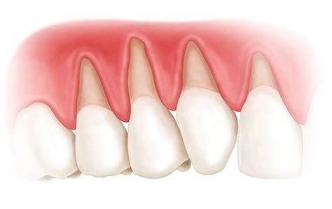 Что такое и как лечить клиновидный дефект зубов Стоматология «АльфаДент в Оренбурге