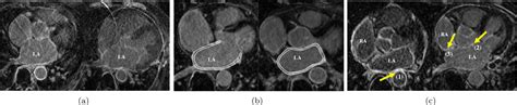 Figure 1 From Atrial Scar Quantification Via Multi Scale Cnn In The Graph Cuts Framework