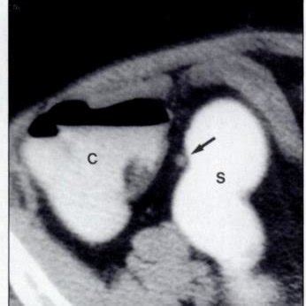 Year Old Woman With Normal Appendix C Cecum Fig 6 Axial CT Scan Download Scientific