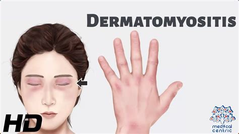 Dermatomyositis Everything You Need To Know Youtube