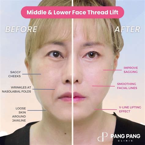 Pangpang Clinic Rejuvenate Your Appearance With Our