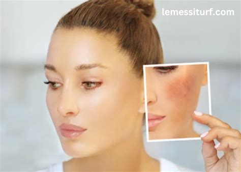 Understanding Hyperpigmentation Common Causes Unveiled