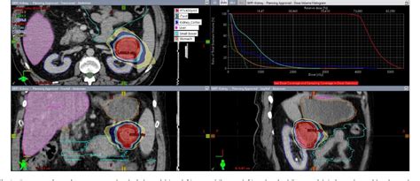 Figure 1 From Phase 2 Trial Of Stereotactic Ablative Radiotherapy For Patients With Primary