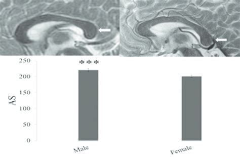 Ratio Of Area Of Splenium AS To Total Area Of Corpus Callosum ACC Download Scientific