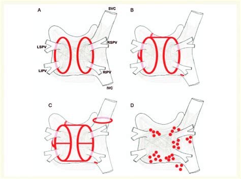 Schematic Of Common Lesion Sets Employed In Af Ablation Figure 3a