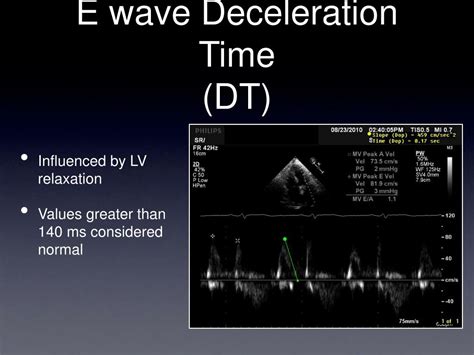 Ppt Ventricular Diastolic Filling And Function Powerpoint Presentation Id 4598551