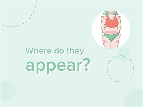 Community Asks The Science Behind Stretch Marks In Sync By Nua