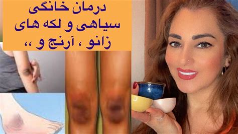 درمان ساده سیاهی و لکه های روی زانو ، آرنج و قوزک پا Youtube