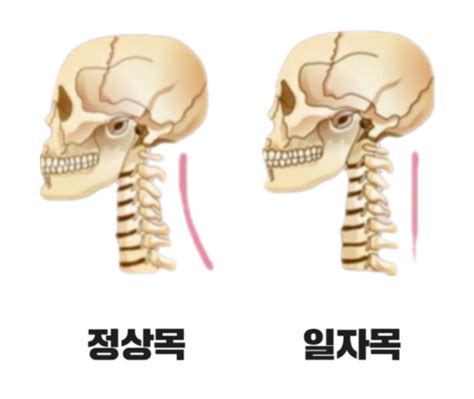 경기광주필라테스 리움필라테스 초월점 일자목 스트레칭 네이버 블로그