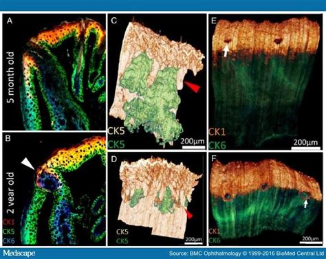 Meibomian Gland Dysfunction Hyperkeratinization Or Atrophy