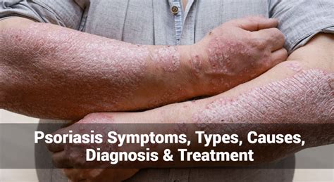 Psoriasis Symptoms Types Causes Diagnosis And Treatment Eczemaless