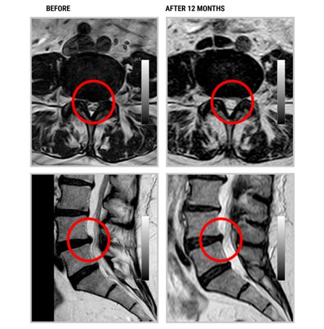Discectomy Before And After