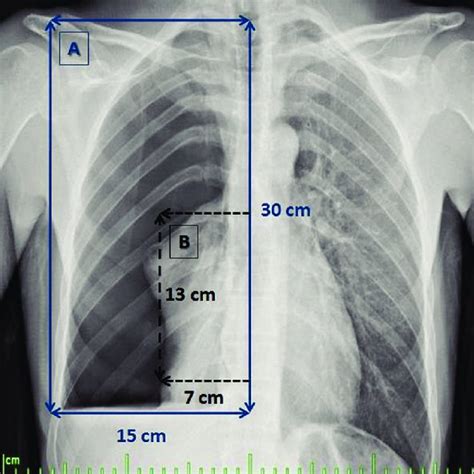 Calculation Of The Size Of Pneumothorax Using The Method Defined By