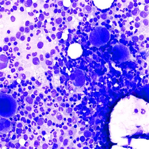 Increased Megakaryocytes In Bone Marrow Associated With Download