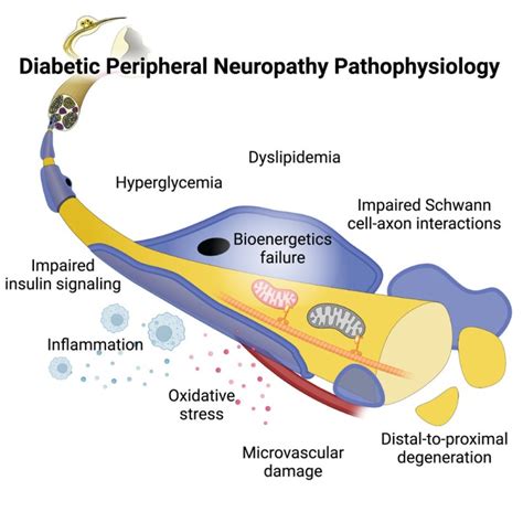 Understanding Diabetic Peripheral Neuropathy Risk Factors Pathophysiology And Current Challenges