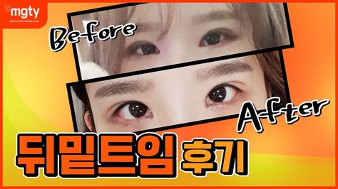 뒤밑트임 후기와 전후사진 마이티성형외과 Youtube