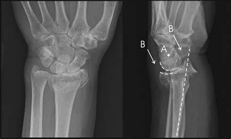 Radiographic Parameters Of Distal Radius Fractures Clinical Tree