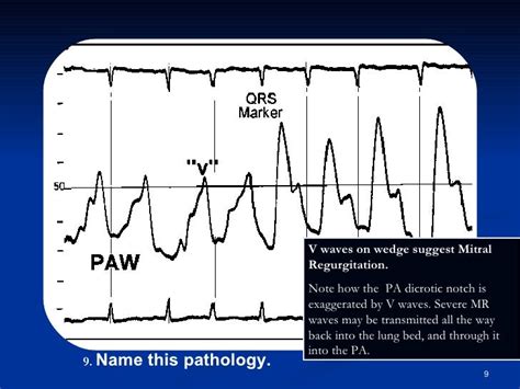 Id Pressure Waveforms