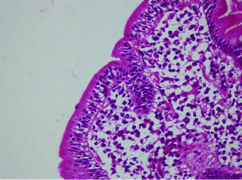 Photomicrograph Showing Increased Intraepithelial Lymphocytes Hande X Download Scientific