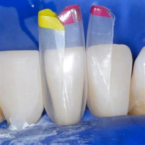 Bioclear Black Triangle Procedure Matrix System Kit