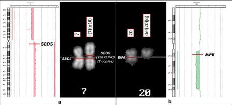 A I 7 Q10 Chromosome With The 2 Copies Of The Sbds Gene Carrying Download Scientific
