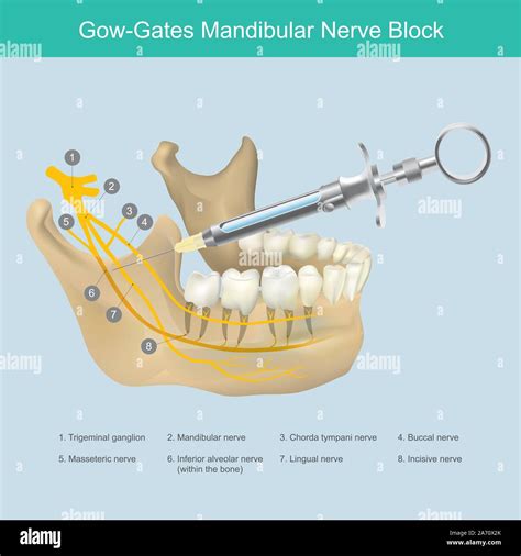 Mandibular Nerve Block
