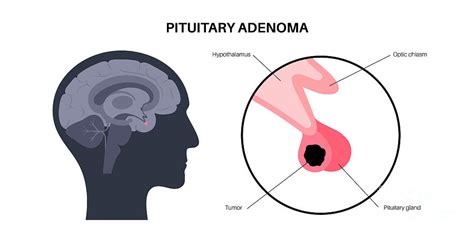 Pituitary Adenoma Cancer Photograph By Pikovit Science Photo Library