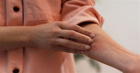 Мазь от сыпи на коже чем лечить сыпь у взрослых