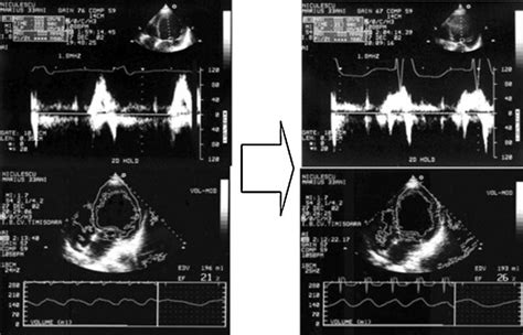 Example Of Improvement Of Lv Abd Pattern Of Contraction And Lv Filling Download Scientific
