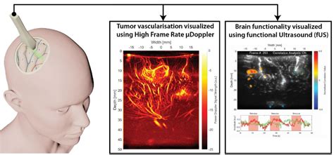 Memristor Implementation Of Compressive Imaging Algorithm For Revolutionary Brain Imaging Theme