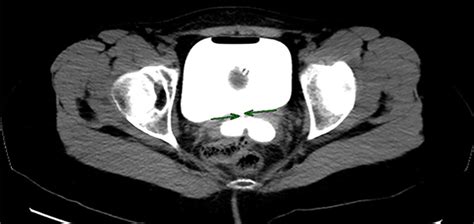 Post Fill Phase Of Ct Cystogram With Both Bladder And Vagina Opacified Download Scientific