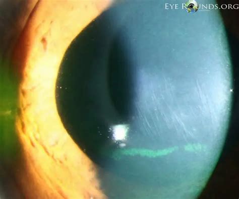 Fleischer Ring Keratoconus