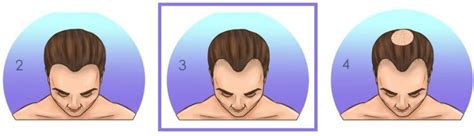 Norwood Scale 3 Hair Transplant 2026 Costs And Medical Process Heva