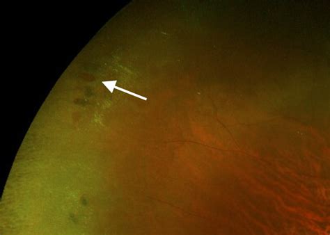 Lattice Degeneration