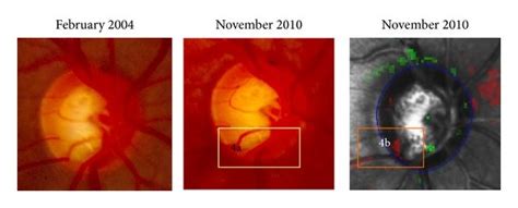 Five Out Of 13 TCA Stable Cases Showing Clinical Progression In All Download Scientific