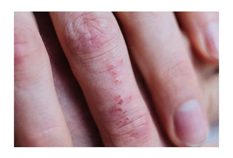 What Does A Scabies Rash Look Like