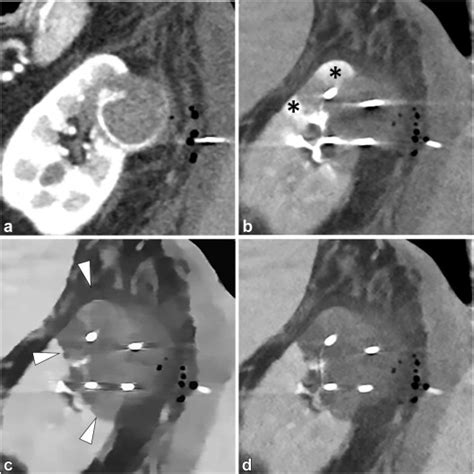 Improved Ice Ball Visualization During Ct Guided Cryoablation Of Renal