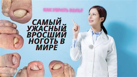 Самый ужасающий вросший ноготь в мире! Интервью с пациентом после ...