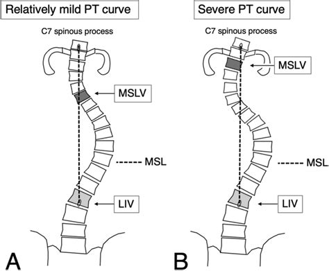 The Msl Is The Line Connecting The Center Of The Spinous Process Of C7 Download Scientific
