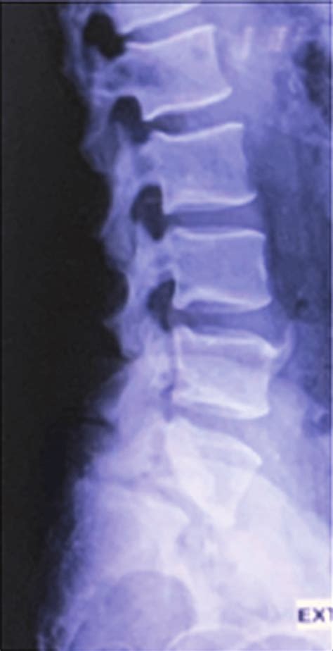 Lateral View Of L S Spine Suggestive Of Traumatic Listhesis And Grade