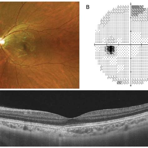 Best Corrected Visually Acuity Bcva Of 23 Patients Before And After