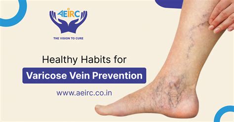 Healthy Habits For Varicose Vein Prevention