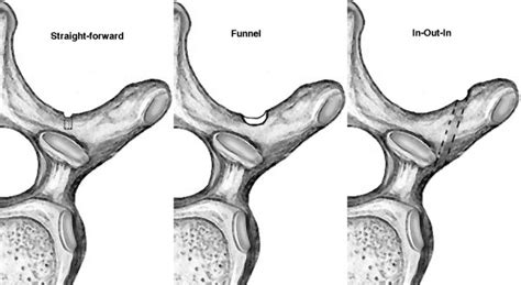 The Three Techniques To Start Thoracic Pedicle Screw Placement